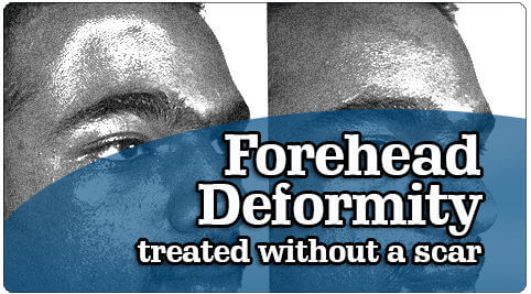 Facial Deformity in the forehead treated without a scar