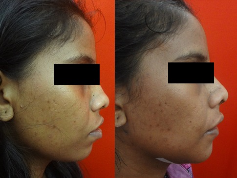 Genioplasty Procedure: Walk with you chin up and head held high