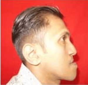 Retrognathic Maxilla | Retrognathic Jaw Surgery in India | Richardsons