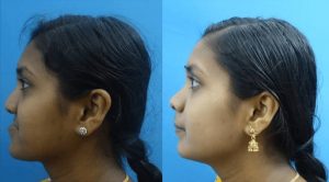 Retrognathic Maxilla | Retrognathic Jaw Surgery in India | Richardsons