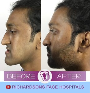 Anterior Maxillary Distraction - Richardson's Plastic Surgery Hospitals