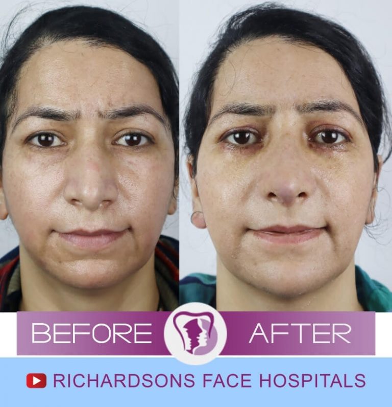 Face Makeover Surgery - Richardson's Plastic Surgery Hospitals