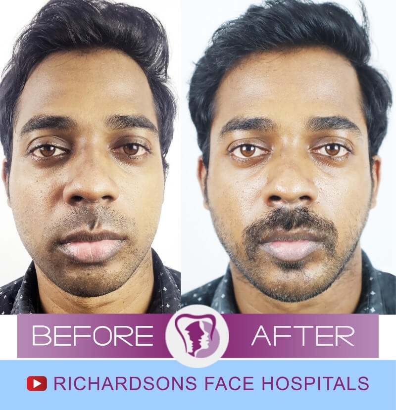 Scar Removal Surgery - Richardson's Plastic Surgery Hospitals