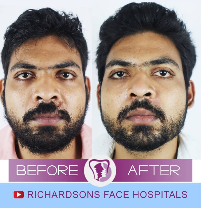Scar Removal Surgery - Richardson's Plastic Surgery Hospitals
