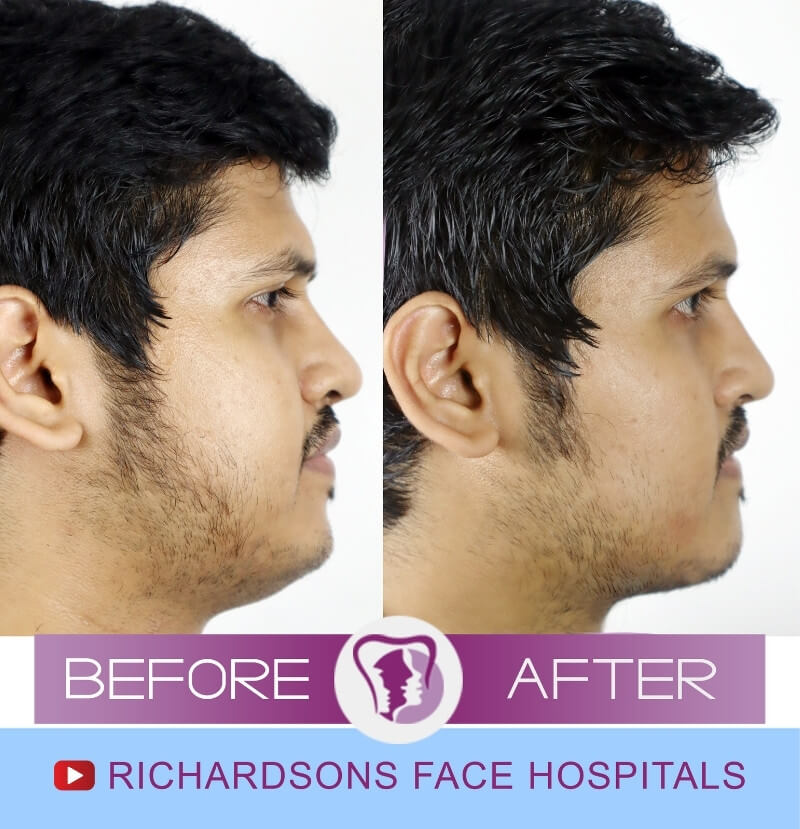 Genioplasty - Richardson's Plastic Surgery Hospitals