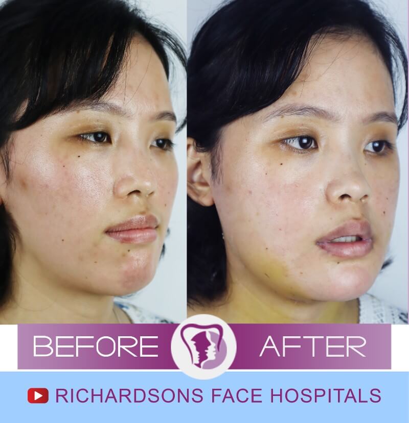 What to Know About An Underbite Surgery Procedure