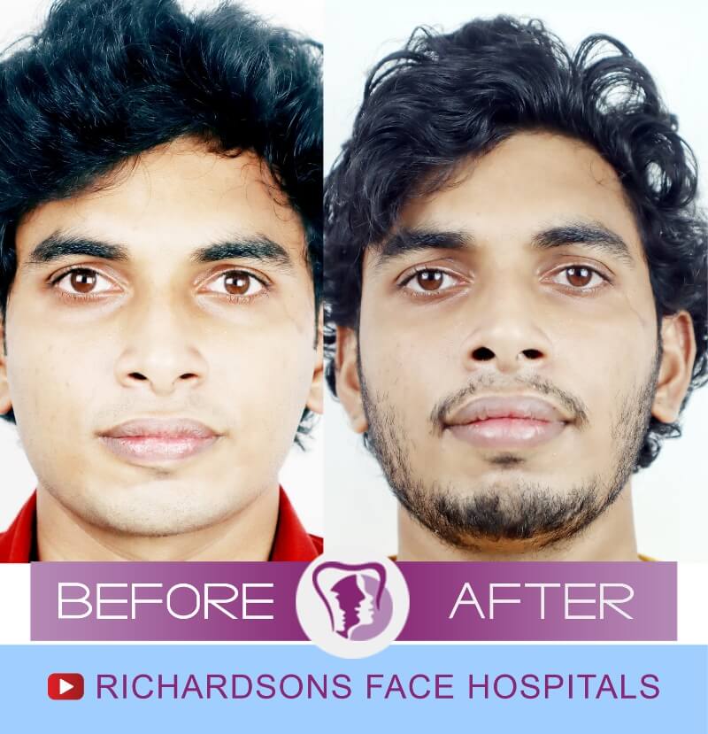 Lip Revision - Richardson's Plastic Surgery Hospitals
